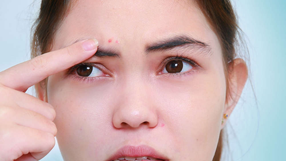 Acne Danger Zones: Face Mapping Your Zits - Calyxta